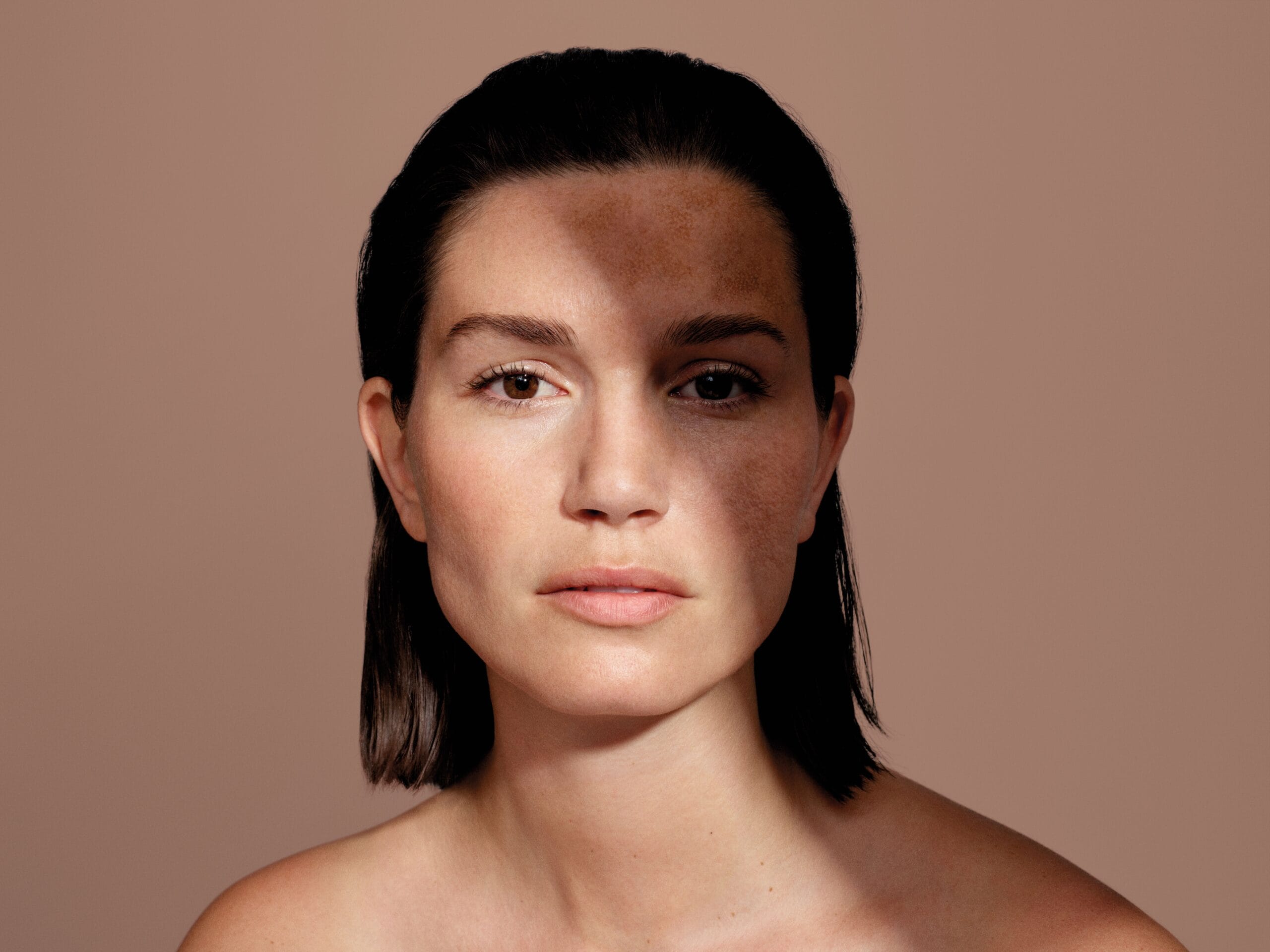 How can pigmentation spots be removed? - Anna Coleman Skin Solutions